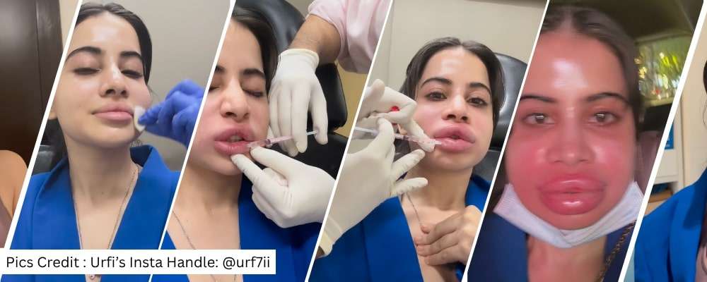 Urfi Javed Face Swelling: The Truth Behind Her Lip Fillers Being Dissolved